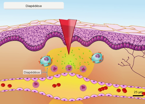 PodEduc - La Réaction Inflammatoire